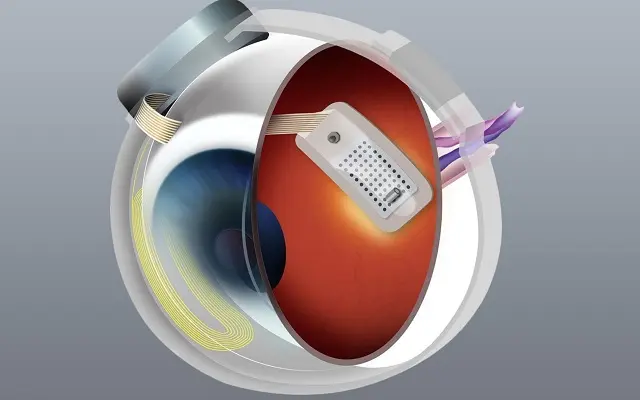 Retinal Implants Market Growth, Share and Analysis 2034